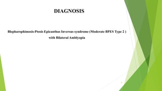 Blepharophimosis Ptosis Epicanthus inversus Syndrome (BPES) | PPTX