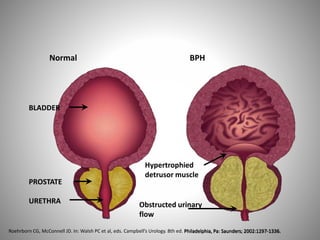Treatment of BPH | PPTX