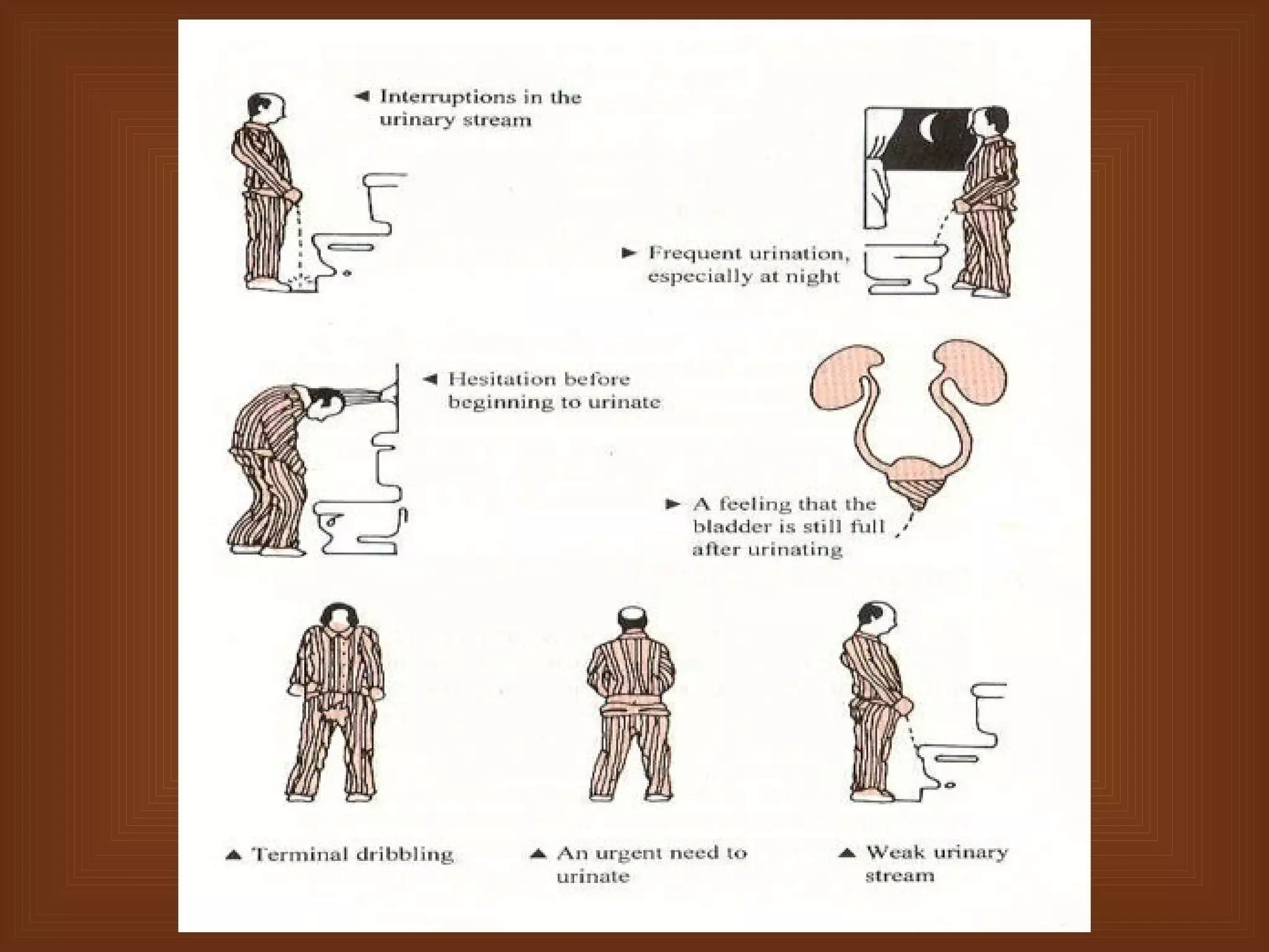 Benign Prostate Hyperplasia & Prostate Cancer | PPT