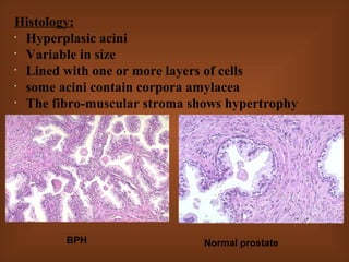 Benign Prostate Hyperplasia & Prostate Cancer | PPT