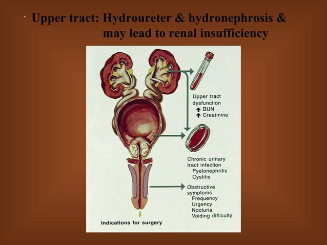 Benign Prostate Hyperplasia & Prostate Cancer | PPT