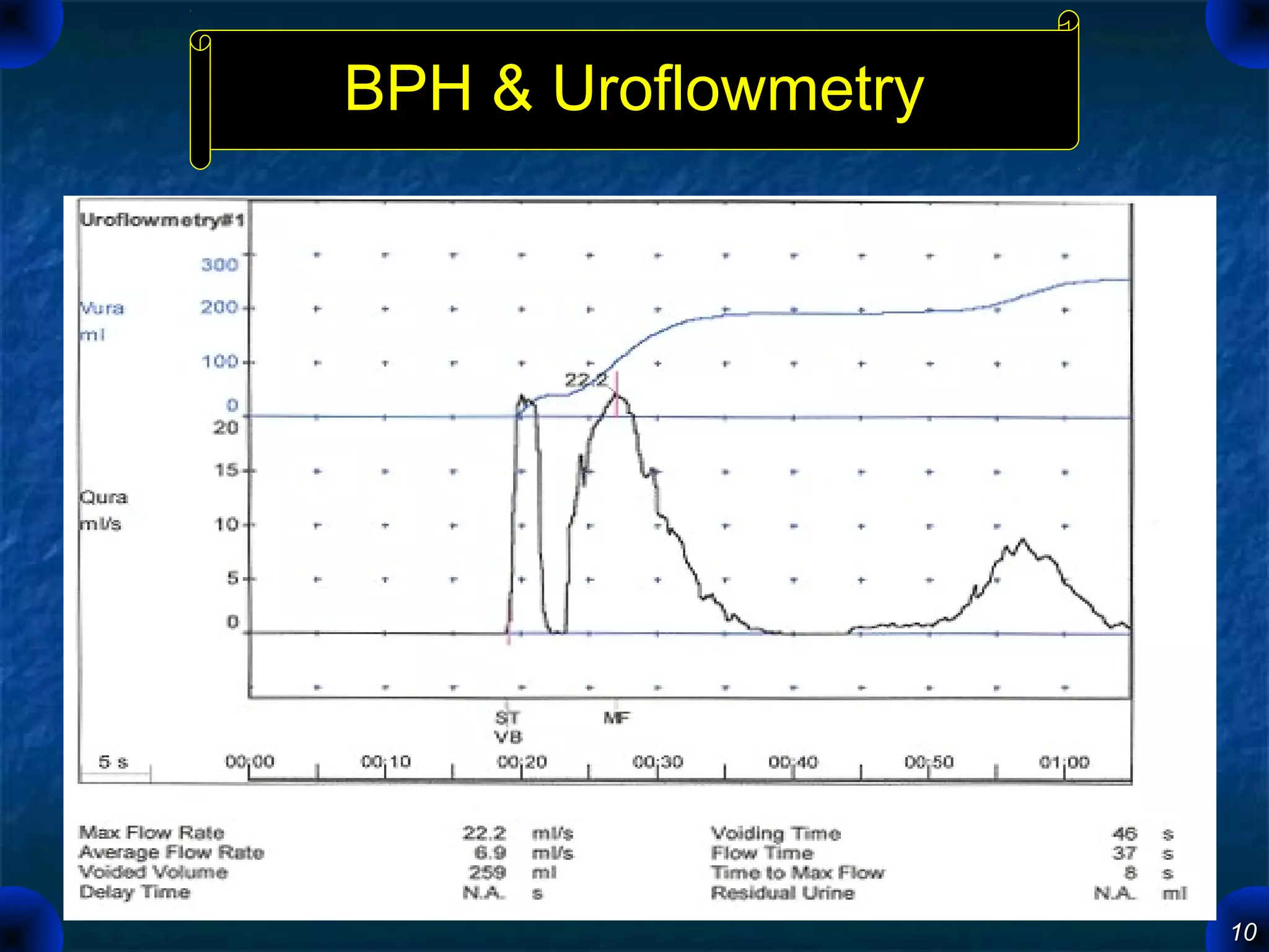 Benign enlargement of prostate . medical therapy | PPT