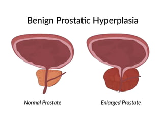 Benign Prostate Hyperplasia | PPTX