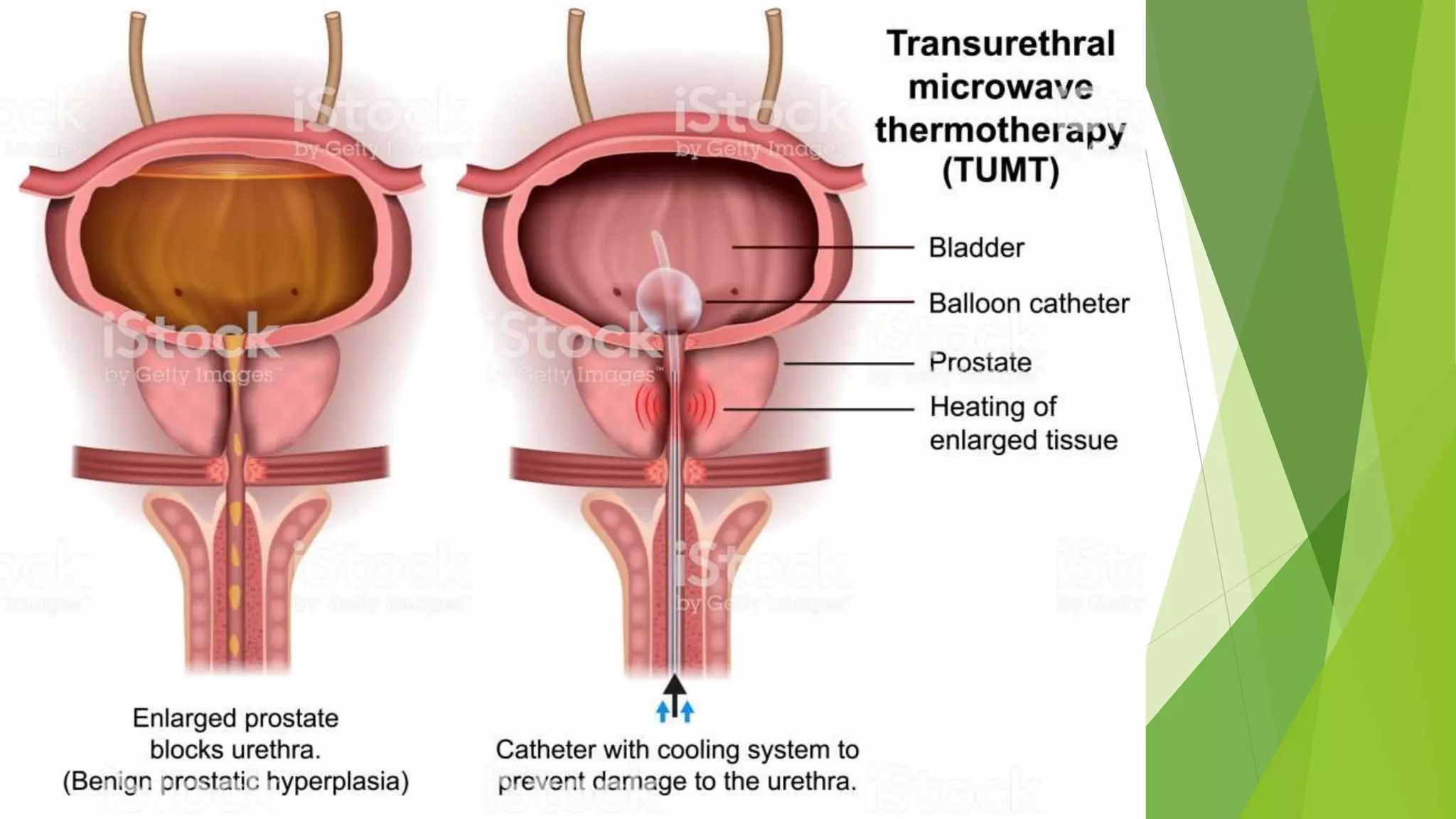 Benign prostatic hyperplasia (BPH) | PPTX