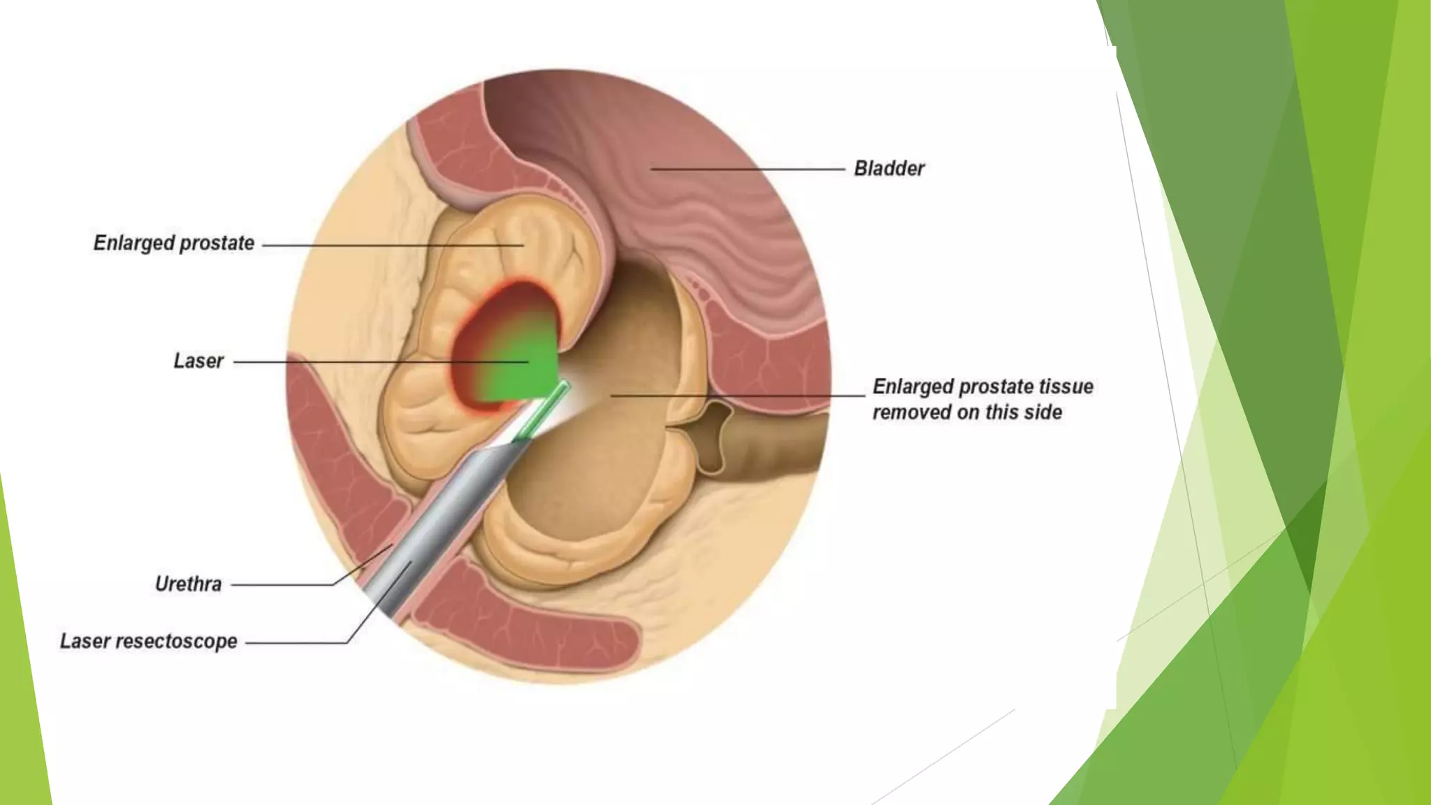 Benign prostatic hyperplasia (BPH) | PPTX