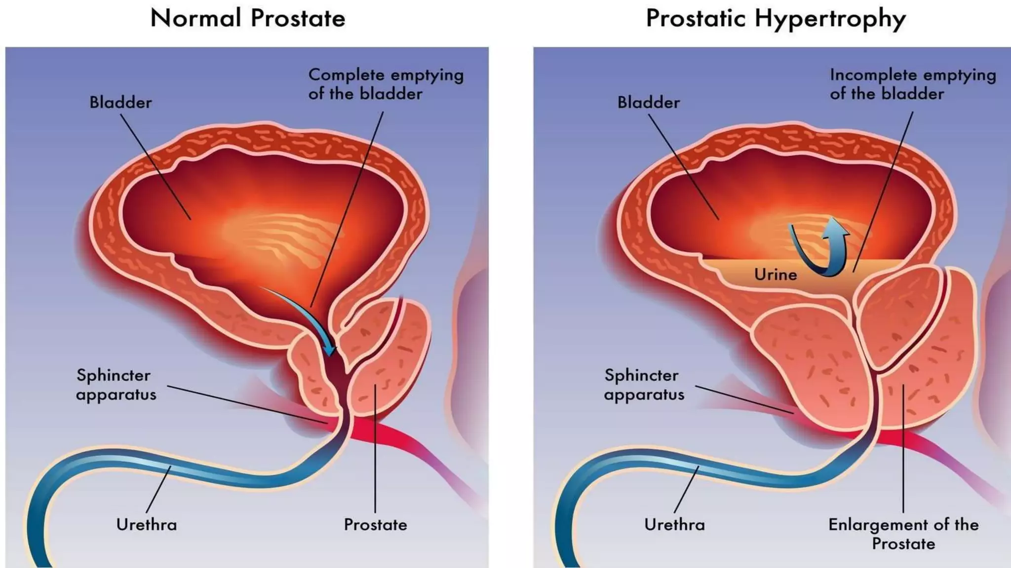 Benign prostatic hyperplasia (BPH) | PPTX