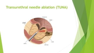 Benign prostatic hyperplasia (BPH) | PPTX