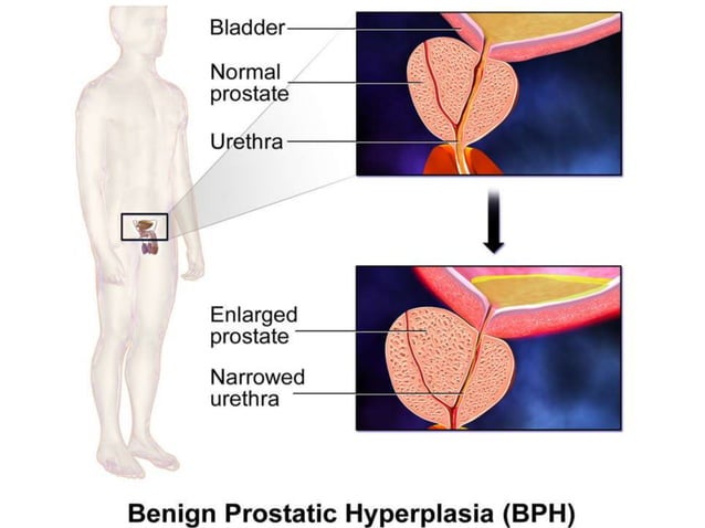 Benign Prostatic Hyperplasia . pptx | PPTX