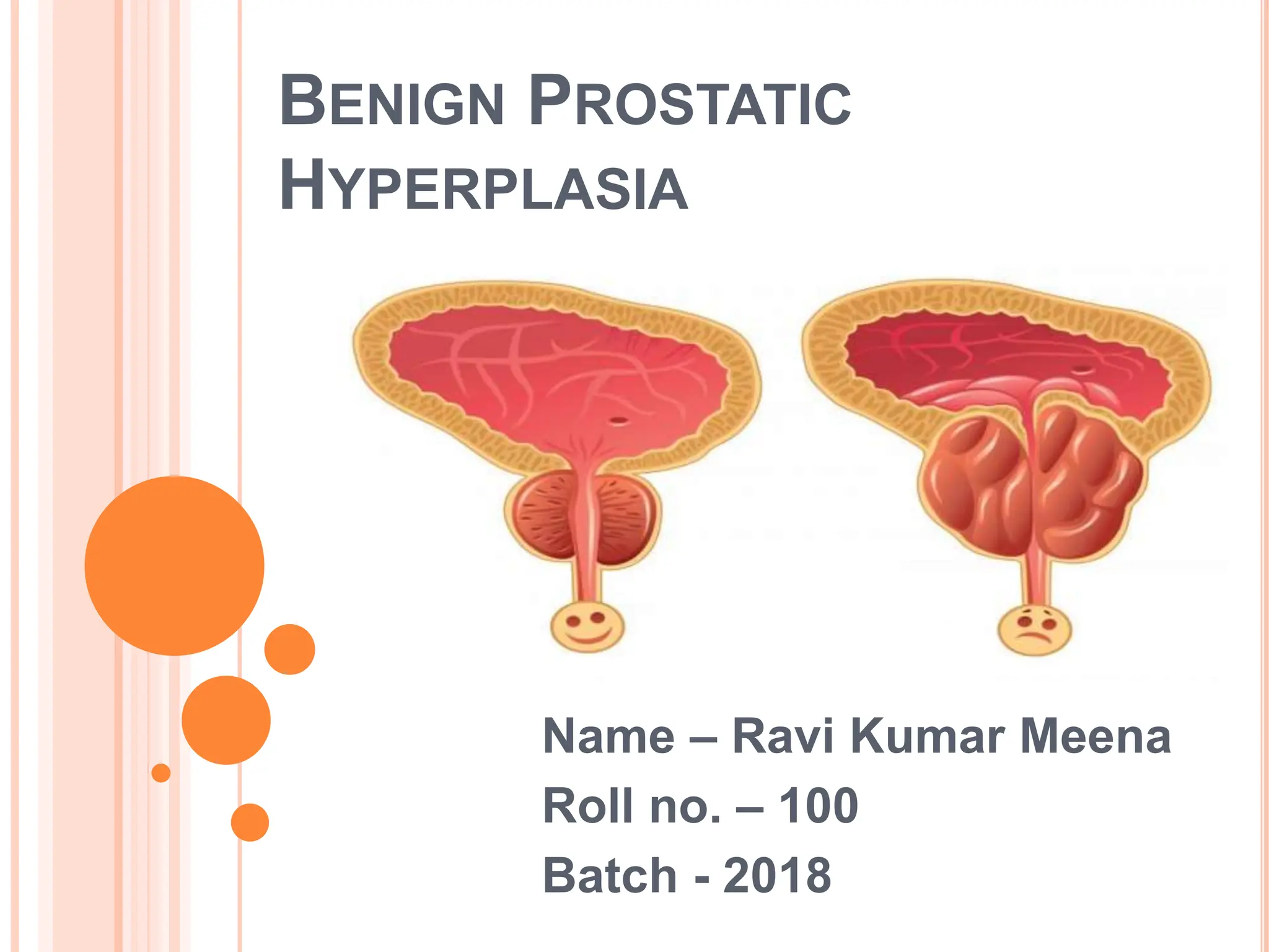 Benign Prostatic Hyperplasia by Dr Ravi Meena | PPT