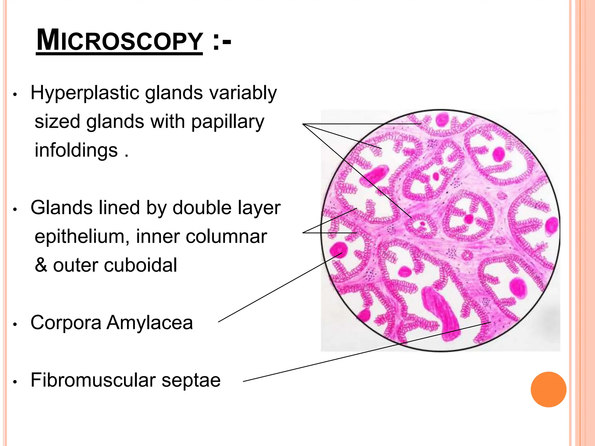 Benign Prostatic Hyperplasia by Dr Ravi Meena | PPT