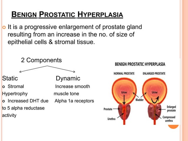 Benign Prostatic Hyperplasia by Dr Ravi Meena | PPT