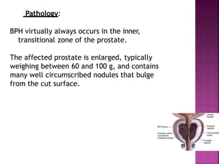 BPH.pptx USEFUL FOR MBBS AND PG STUDENTS OF PATHOLOGY | PPT