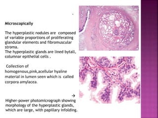 BPH.pptx USEFUL FOR MBBS AND PG STUDENTS OF PATHOLOGY | PPT