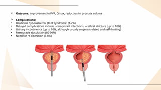 BPH (benign prostatic hyperplasia) in urology | PPTX