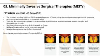 BPH (benign prostatic hyperplasia) in urology | PPTX