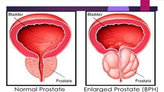 Disorders of prostate - Benign hypertrophy of prostate.pptx