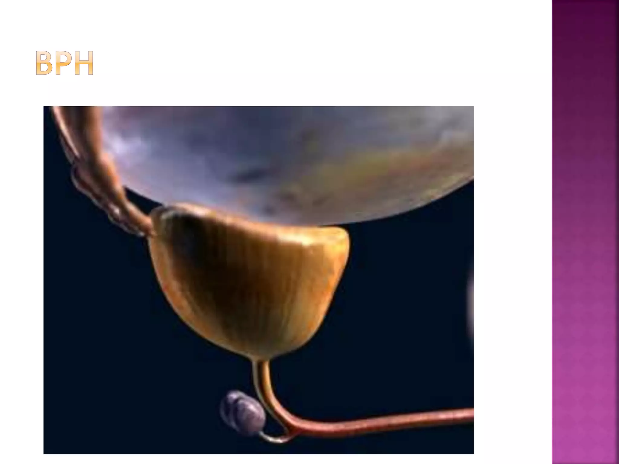 BPH- SURGICAL MANAGMENT.pptx