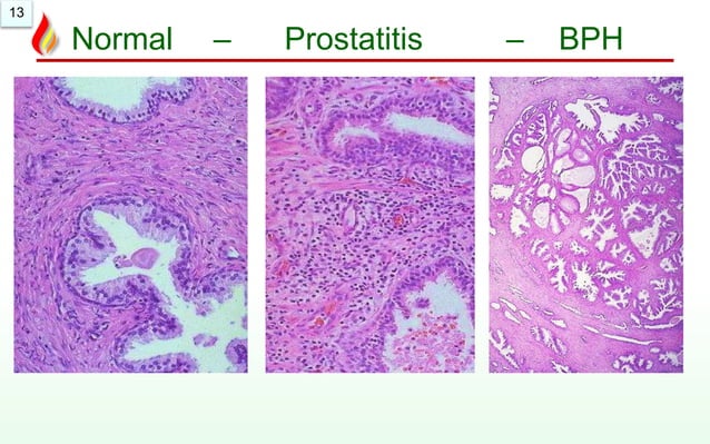 Pathology of Prostate - Benign | PPTX