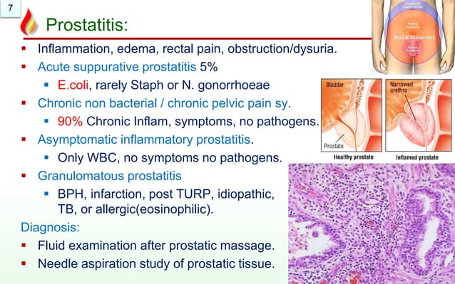 Pathology of Prostate - Benign | PPTX