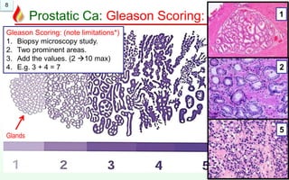 Pathology of Prostate - Cancer | PPTX
