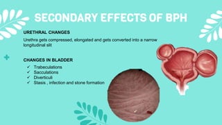 benign prostatic hyperplasia and carcinoma.pptx