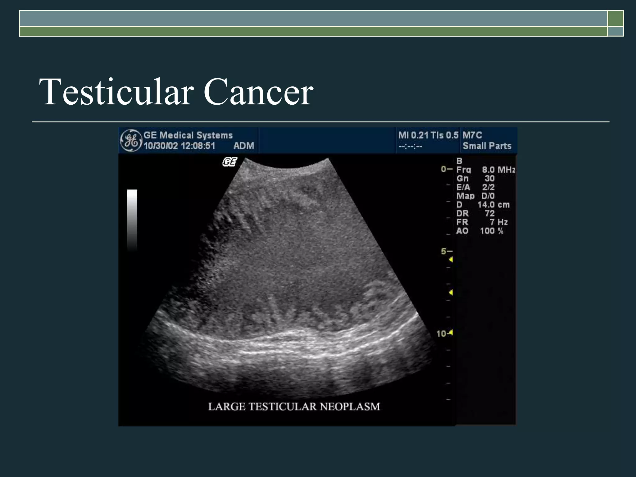BPH, Prostate Cancer, Testicular Cancer | PPTX