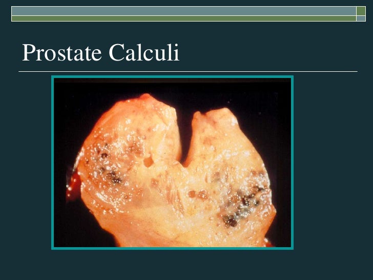 BPH, Prostate Cancer, Testicular Cancer