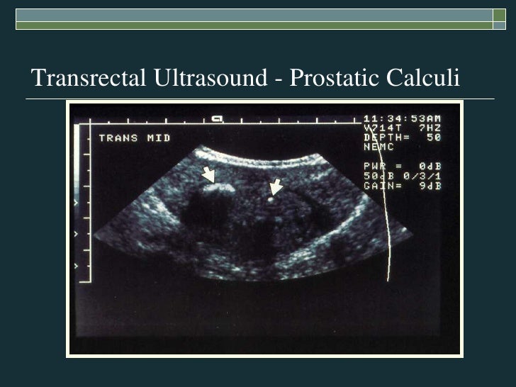 BPH, Prostate Cancer, Testicular Cancer