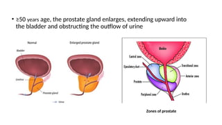 PHARMACOTHERAPY OF BENIGN PROSTATIC HYPERPLASIA .pptx