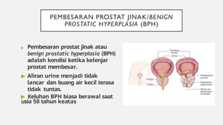 BPH dan BSK (Batu Saluran Kencing).pptx. | PPT