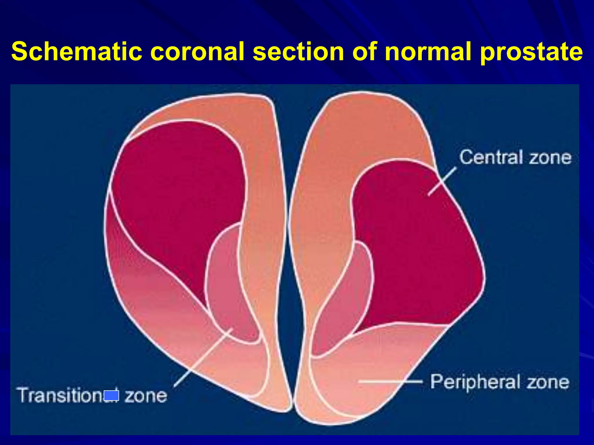 Benign prostatic hyperplasia by Sayed Eleweedy | PPT