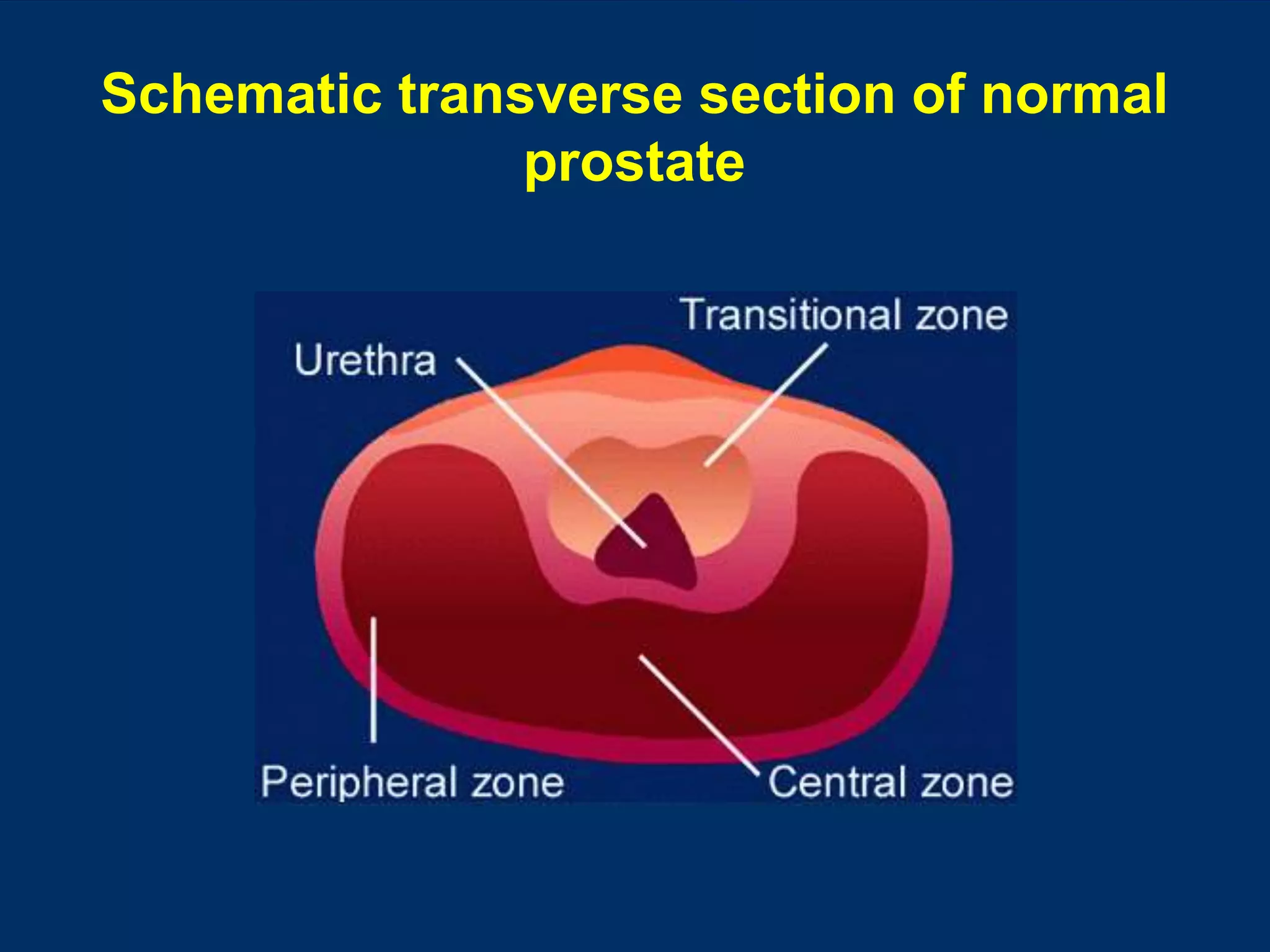 Benign prostatic hyperplasia by Sayed Eleweedy | PPT