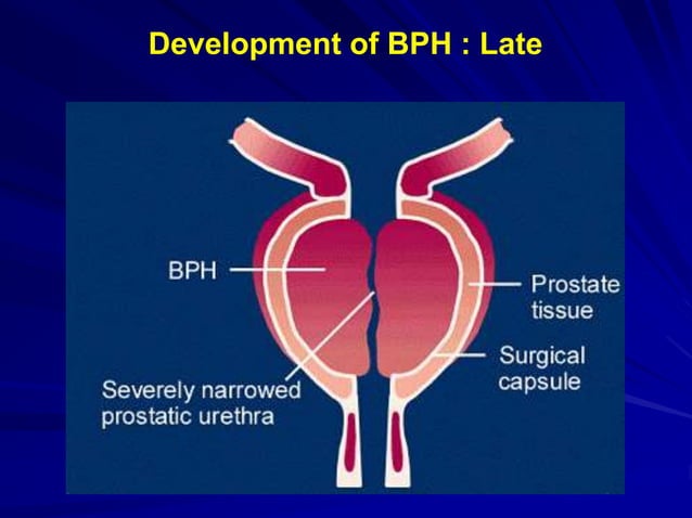 Benign prostatic hyperplasia by Sayed Eleweedy | PPT