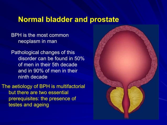 Benign prostatic hyperplasia by Sayed Eleweedy | PPT