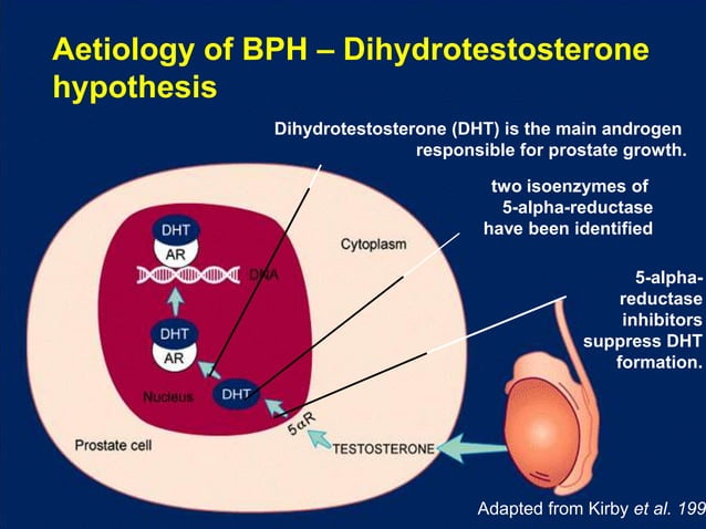 Benign prostatic hyperplasia by Sayed Eleweedy | PPT