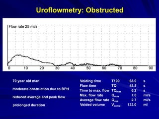 Benign prostatic hyperplasia by Sayed Eleweedy | PPT
