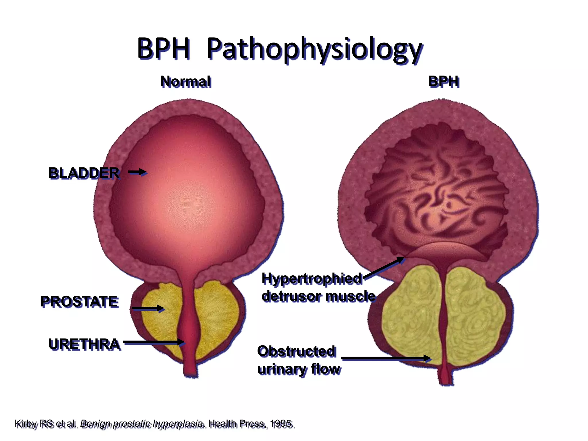 BPH & its management by Dr Nesar | PPTX