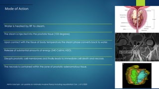 Benign prostatic hyperplasia minimal invasive surgery | PPTX