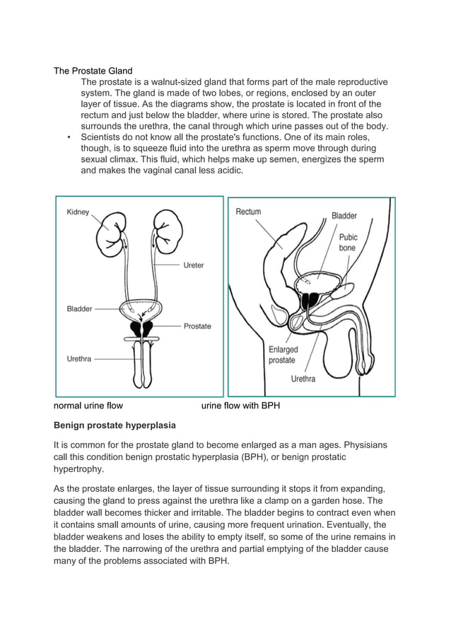 Bph presentation | PDF | Hormonal Disorders | Endocrine and Metabolic ...
