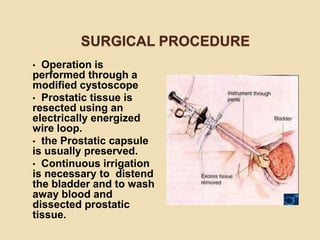 benign prostatic hyperplasia urology lectures | PPTX