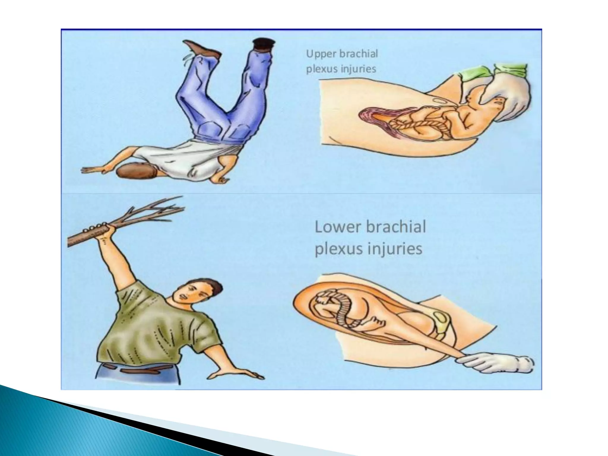 BRACHIAL PLEXUS INJURY: EVALUATION AND MANAGEMENT | PDF