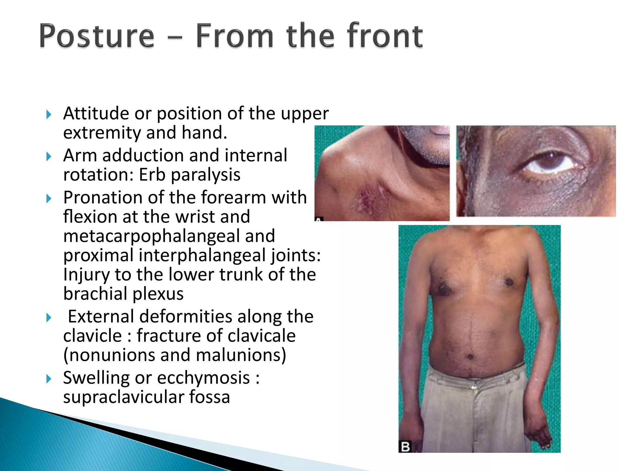 BRACHIAL PLEXUS INJURY: EVALUATION AND MANAGEMENT | PDF