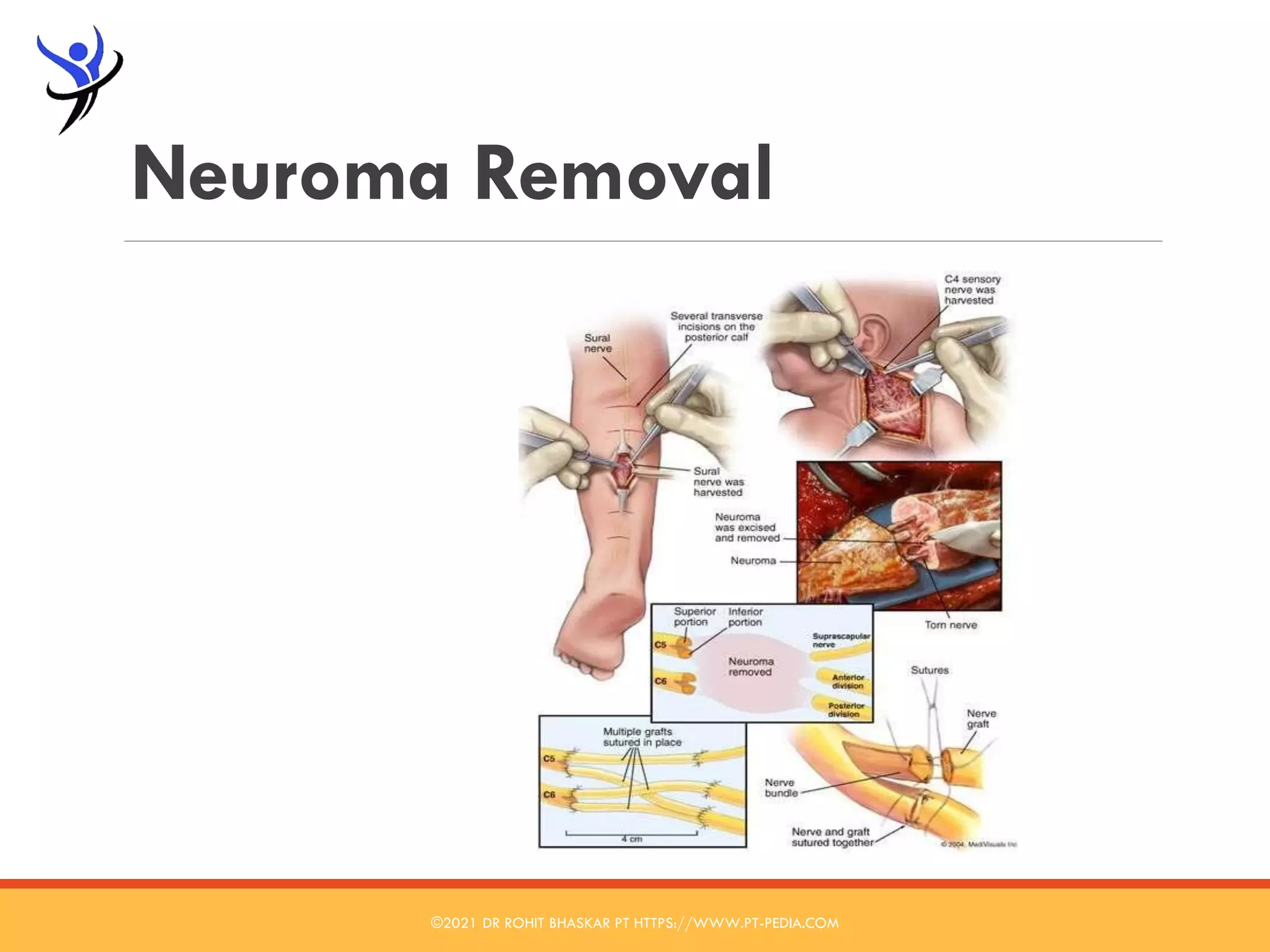 BRACHIAL PLEXUS INJURY - Dr Rohit Bhaskar | PDF
