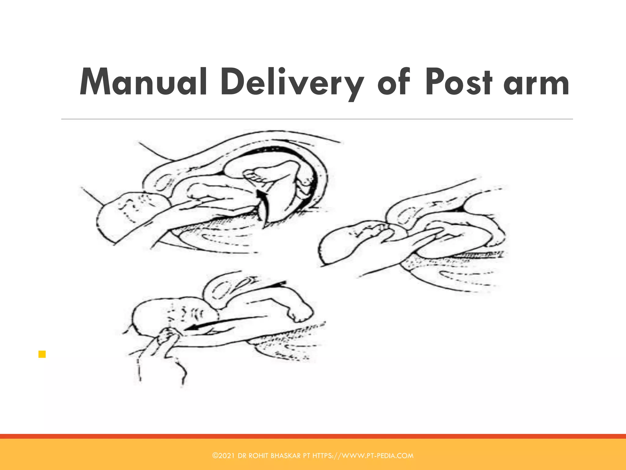 BRACHIAL PLEXUS INJURY - Dr Rohit Bhaskar | PDF