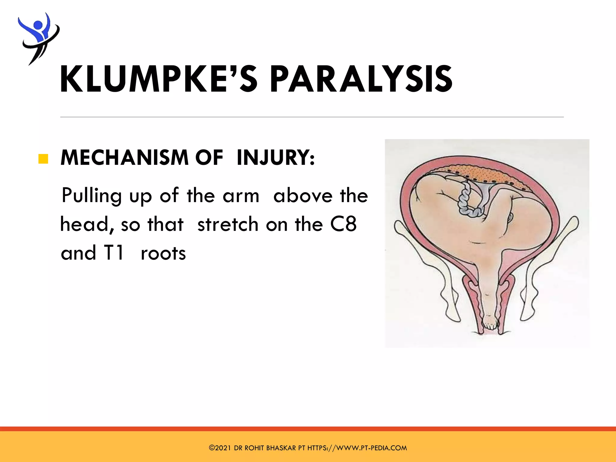 BRACHIAL PLEXUS INJURY - Dr Rohit Bhaskar | PDF