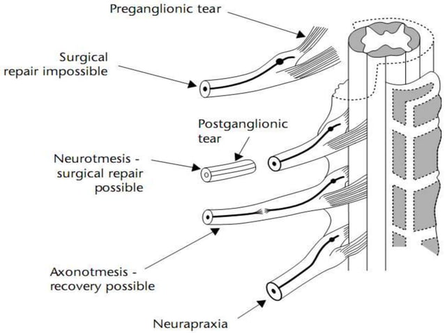 Brachial plexus surgery (simple introduction) | PPTX