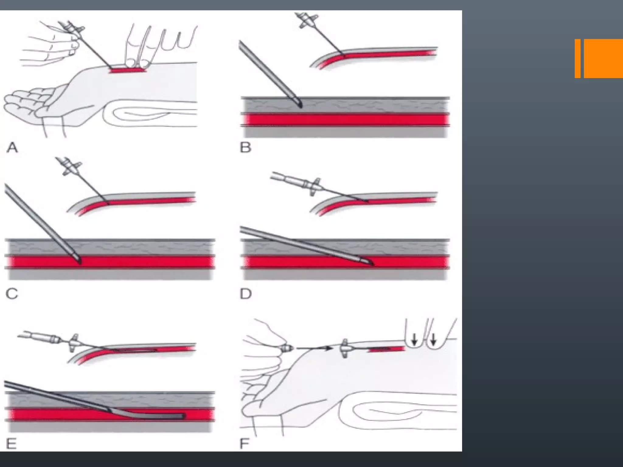 Non Invasive and Invasive Blood pressure monitoring RRT | PPT