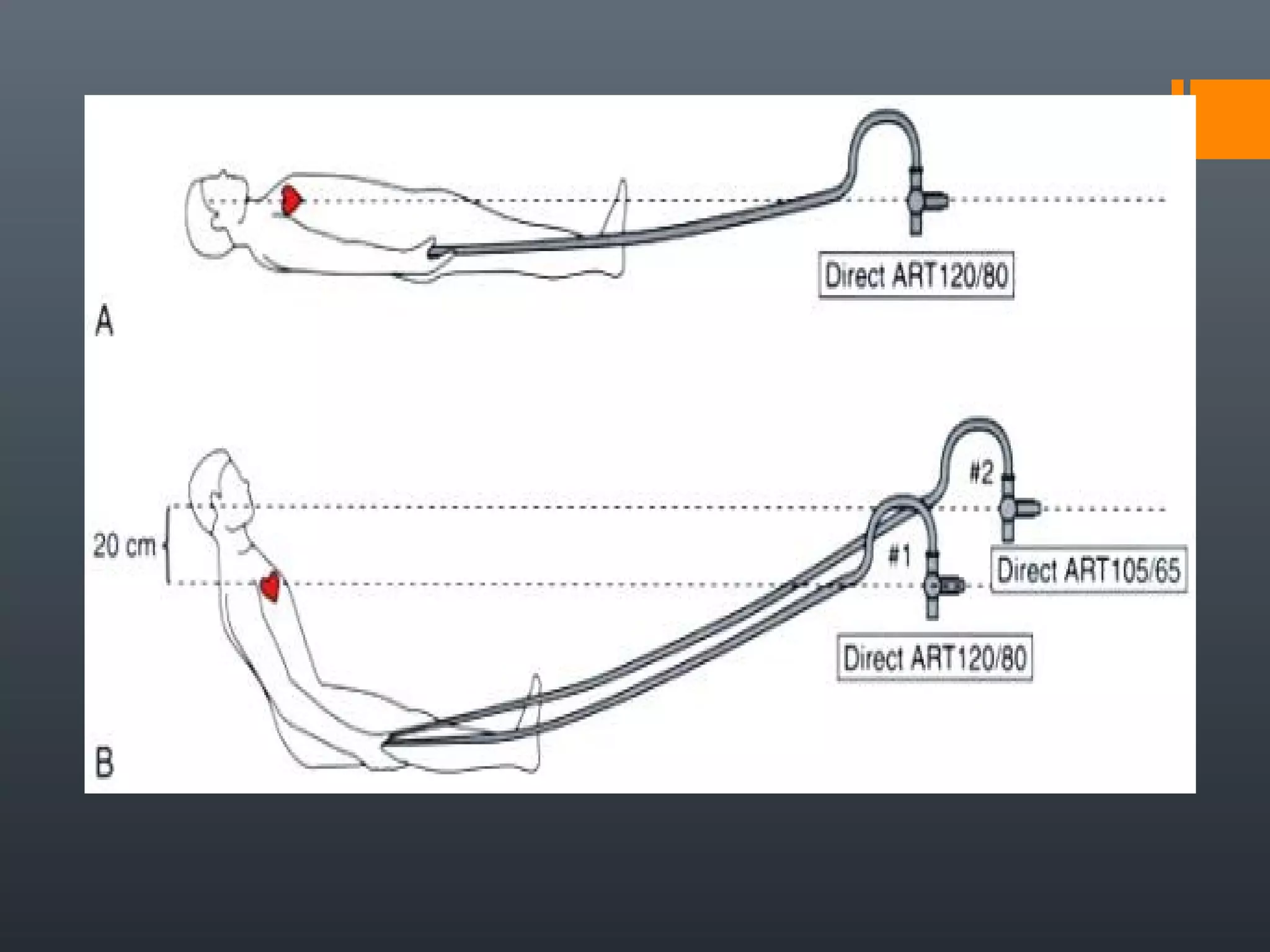 Non Invasive and Invasive Blood pressure monitoring RRT | PPT