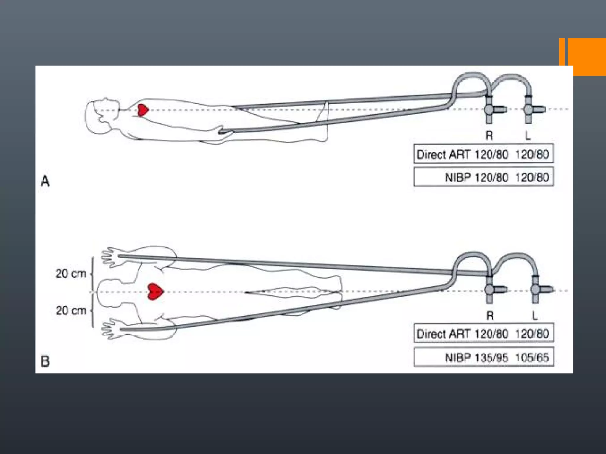 Non Invasive and Invasive Blood pressure monitoring RRT | PPT