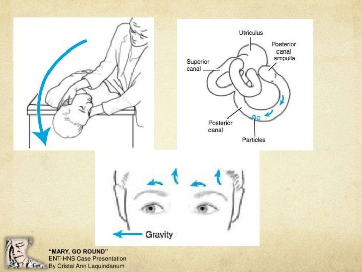 Benign Positional Vertigo Home Exercises